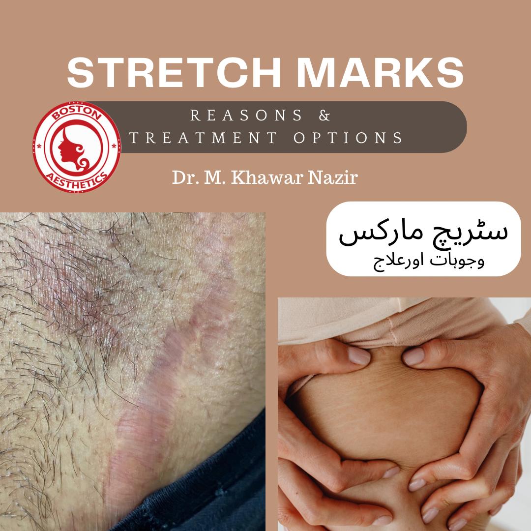اسٹریچ مارکس | Stretch Marks - Boston Aesthetics