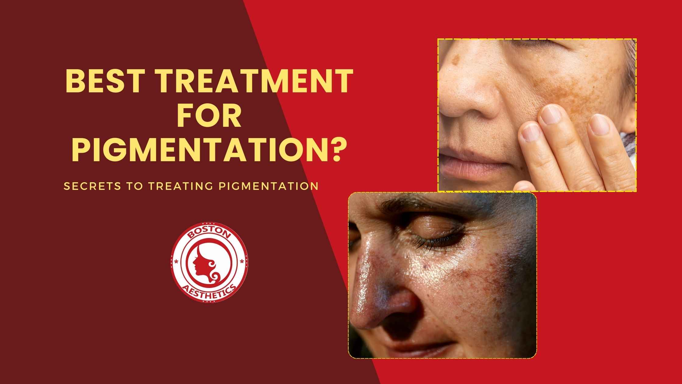 Pigmentation Treatment - Boston Aesthetics