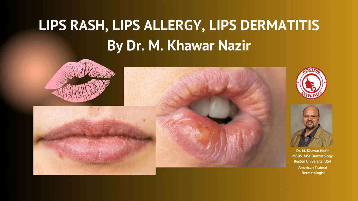 Understanding Lips Allergy, Lips Rash and Lips Dermatitis – Boston ...