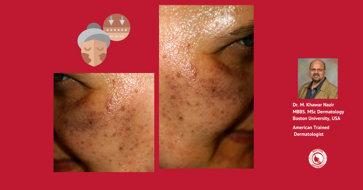 Best Treatment for Pigmentation? - Boston Aesthetics