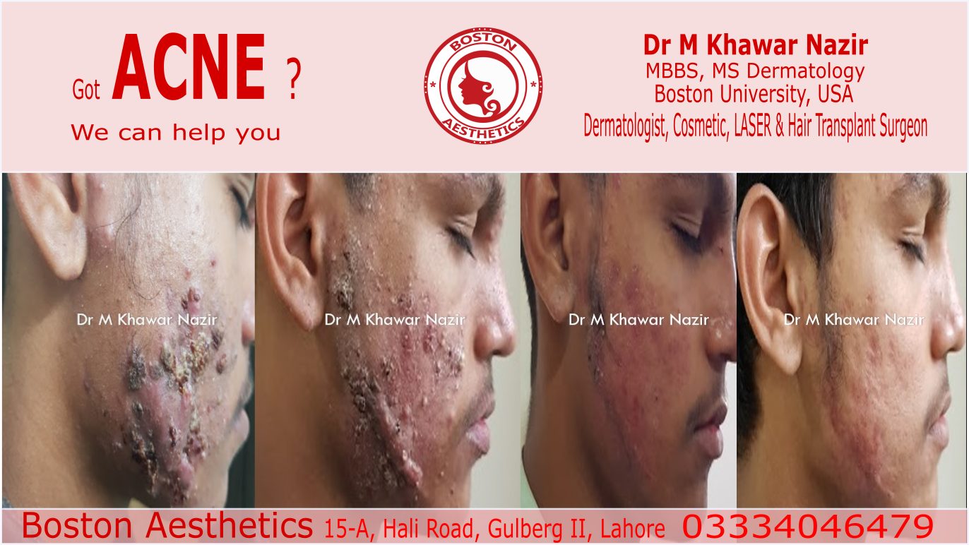 Secrets to Acne Management: A Comprehensive Guide - Boston Aesthetics