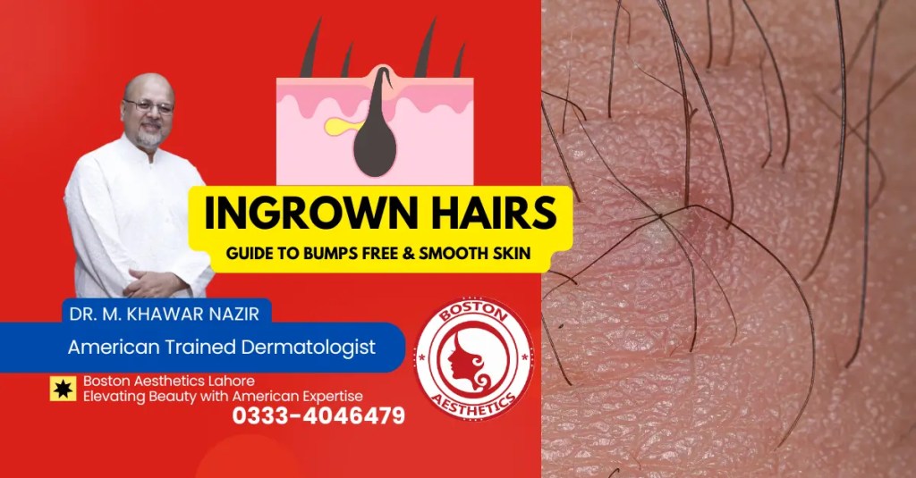 Ingrown Hairs: Guide to Smooth Skin in Lahore – Boston Aesthetics