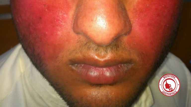 Risks of Using Steroids for Fungal Infections - Boston Aesthetics